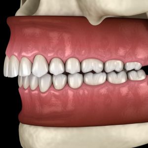 What is a Class 1 Malocclusion? | Dental Information