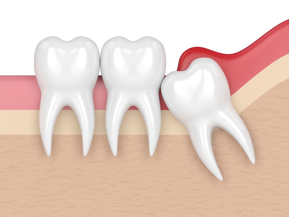 Qu’est-ce qu’une dent semi-incluse? | Explications maxillo-faciales