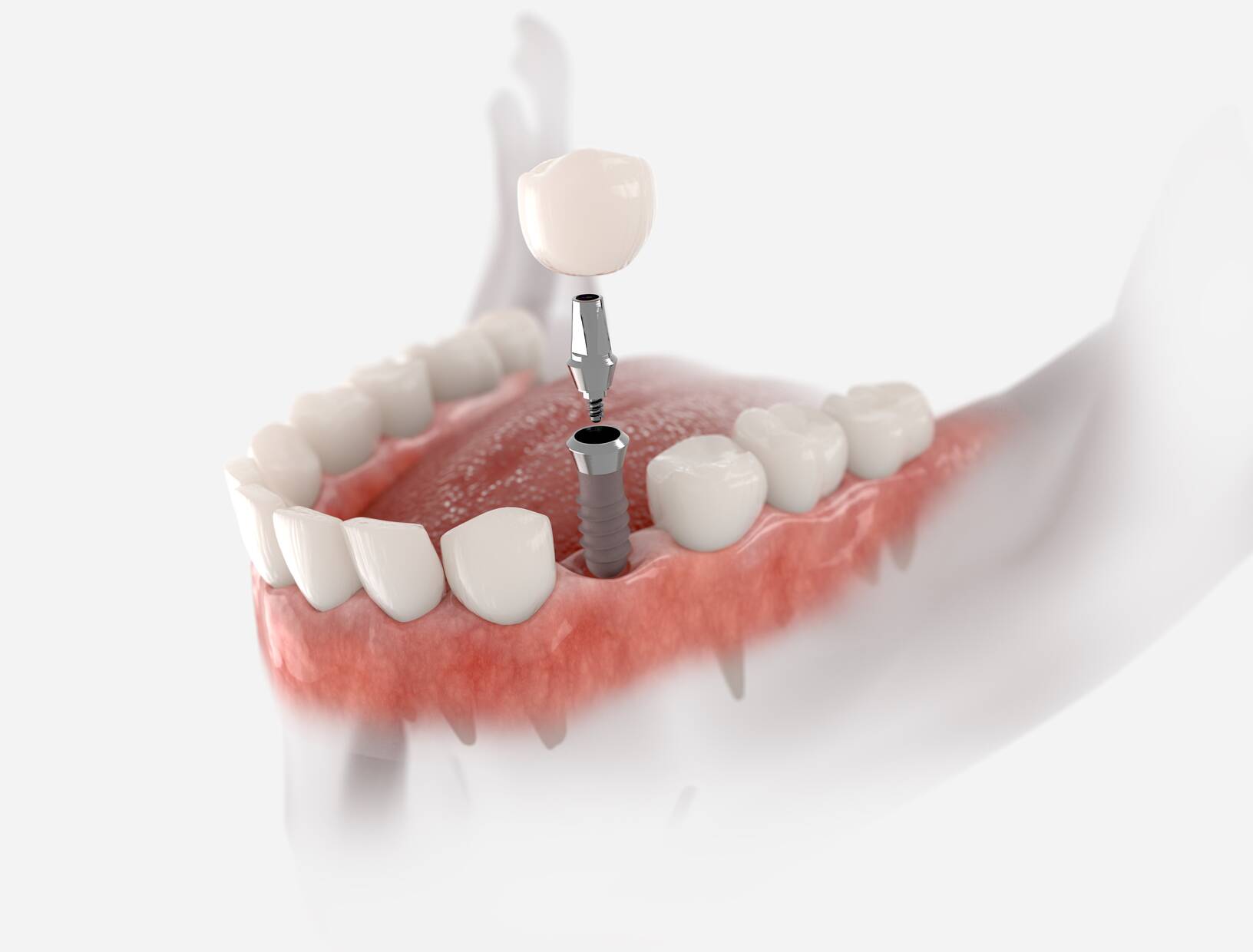 Instructions post-opératoires – Pose d'implants | Clinique MFML